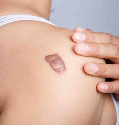 Tratamientos Quirúrgicos - Jury Estetica - Dermatologia